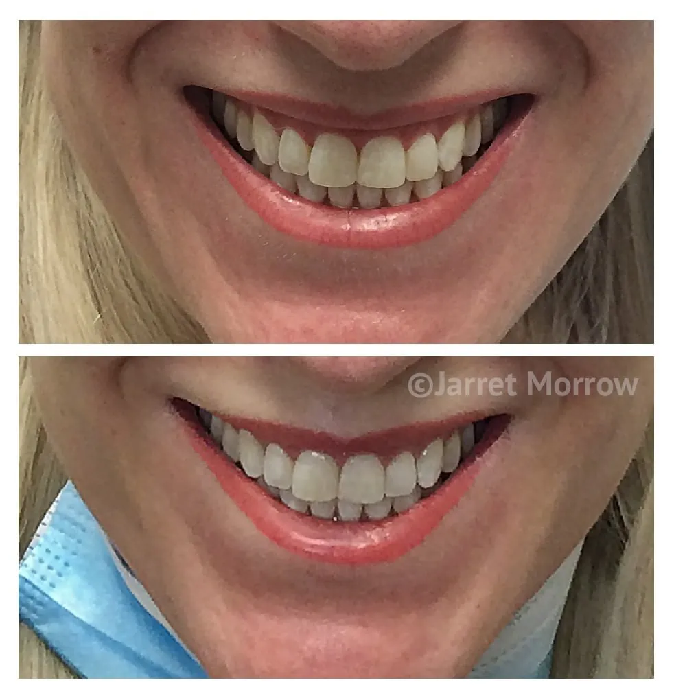 Botox Injections for Facial Slimming and TMJ Pain